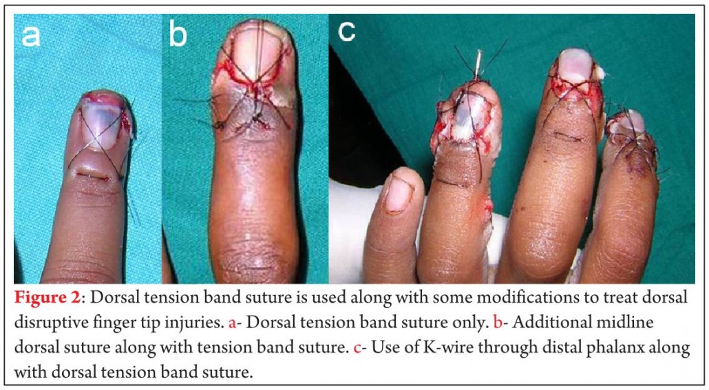 Finger Tip Injury Nail Bed Laceration Partial Nail Plate Avulsion Finger Tip Injury Nail Bed Laceration Partial Nail Plate Avulsion
