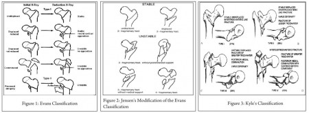 Classifications of Intertrochanteric fractures and their Clinical ...