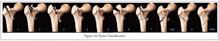 Classifications of Intertrochanteric fractures and their Clinical ...