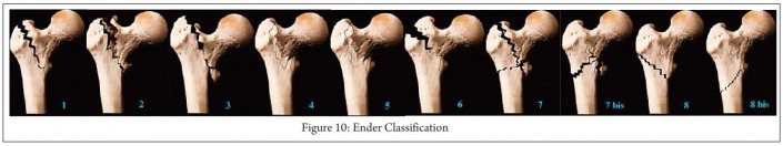 Classifications of Intertrochanteric fractures and their Clinical ...