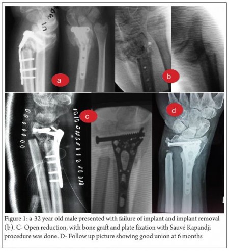 Nonunion distal radius fracture - Case series of 6 cases with Review of ...