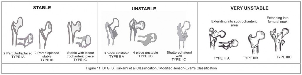 Classifications of Intertrochanteric fractures and their Clinical ...