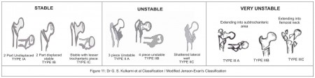 Classifications of Intertrochanteric fractures and their Clinical ...