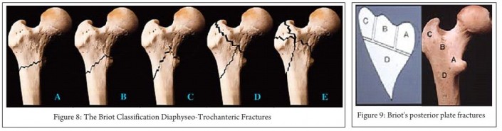 Intertrochanteric fractures Archives - Trauma International