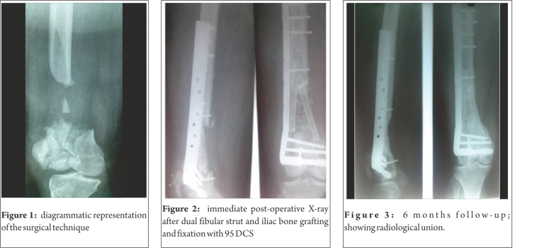 fibular strut graft Archives - Trauma International