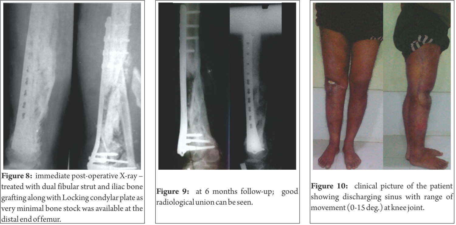 A Unique Modality for treating Open Supracondylar fracture Femur with ...