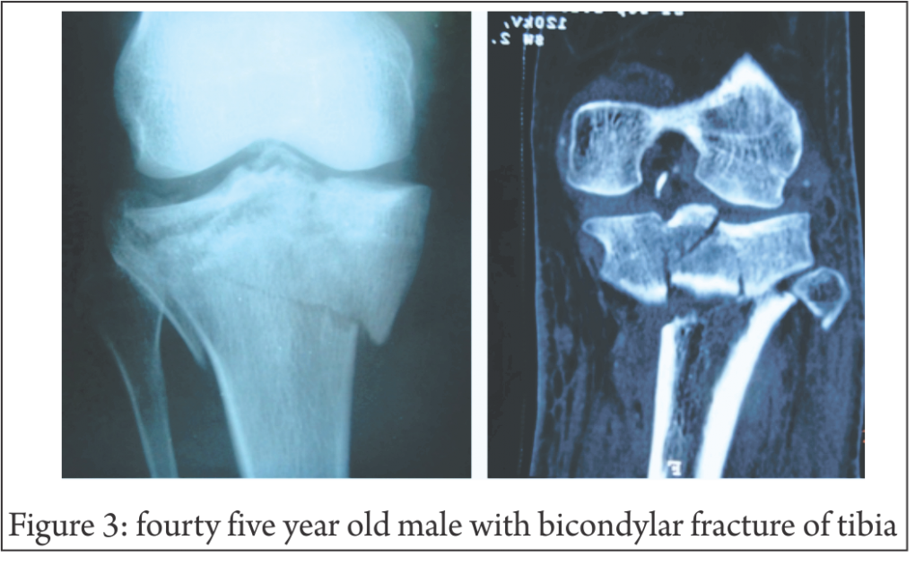 Fixation of Inter-condylar Eminence fragment in Bi-condylar Tibial ...