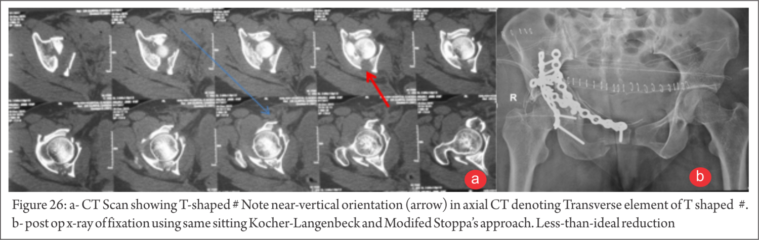 Understanding Clinical Radiology of Fracture Acetabulum – Trauma ...