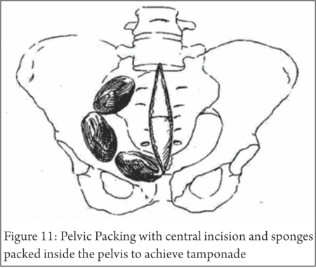 Emergency Management of Pelvic Fractures – Trauma International