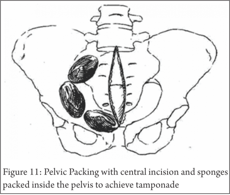 Emergency Management of Pelvic Fractures – Trauma International