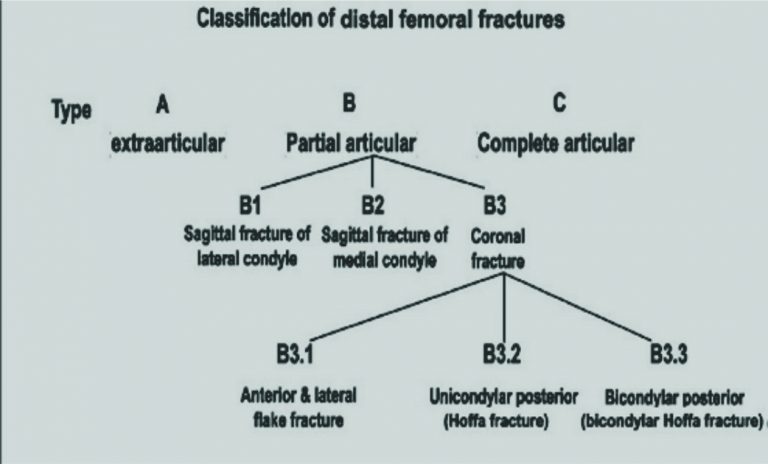 Classification of Distal Femur Fractures and Their Clinical Relevance ...
