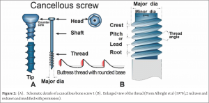 Biomechanics of Cancellous Screw – Trauma International