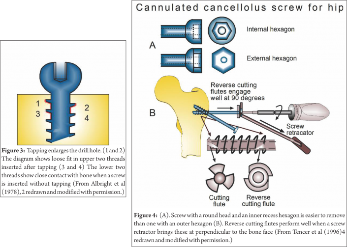 Biomechanics of Cancellous Screw – Trauma International