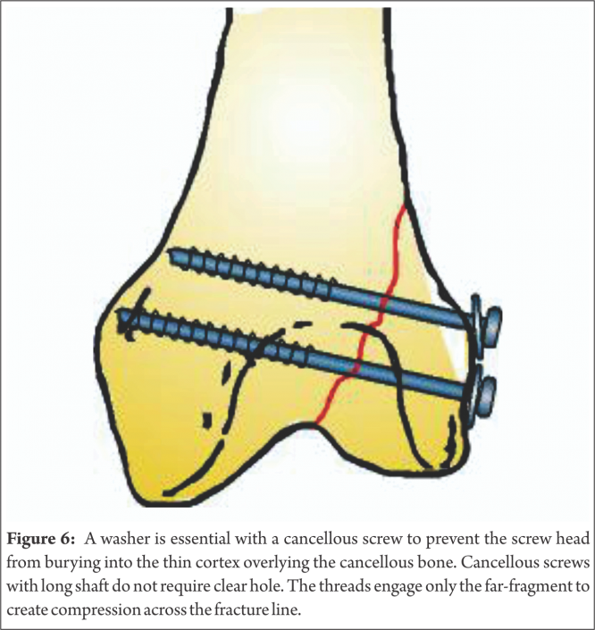 Biomechanics of Cancellous Screw - Trauma International