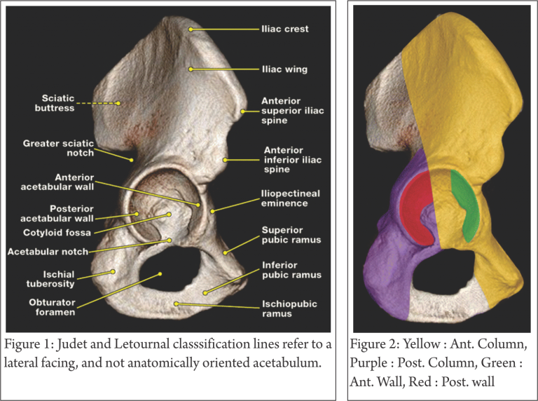 Understanding Clinical Radiology of Fracture Acetabulum – Trauma ...