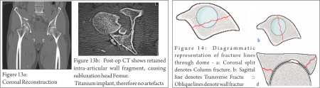 Understanding Clinical Radiology of Fracture Acetabulum – Trauma ...