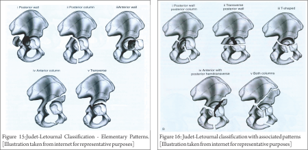 Digastric Trochantric Flip OsteDigastric Trochantric Flip Osteotomy ...