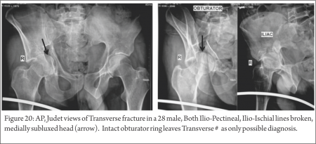 Understanding Clinical Radiology of Fracture Acetabulum – Trauma ...