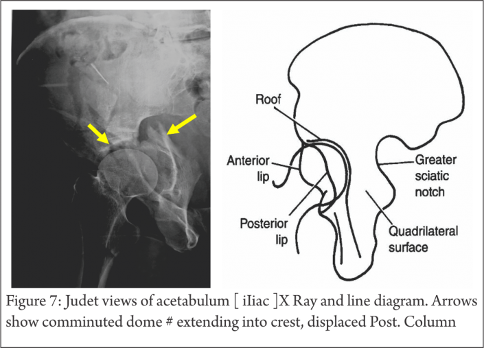 Understanding Clinical Radiology of Fracture Acetabulum – Trauma ...
