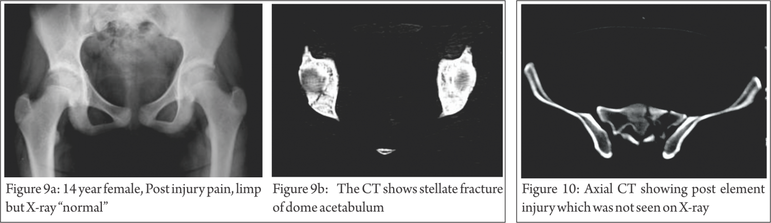 Understanding Clinical Radiology of Fracture Acetabulum – Trauma ...