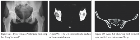Understanding Clinical Radiology of Fracture Acetabulum – Trauma ...