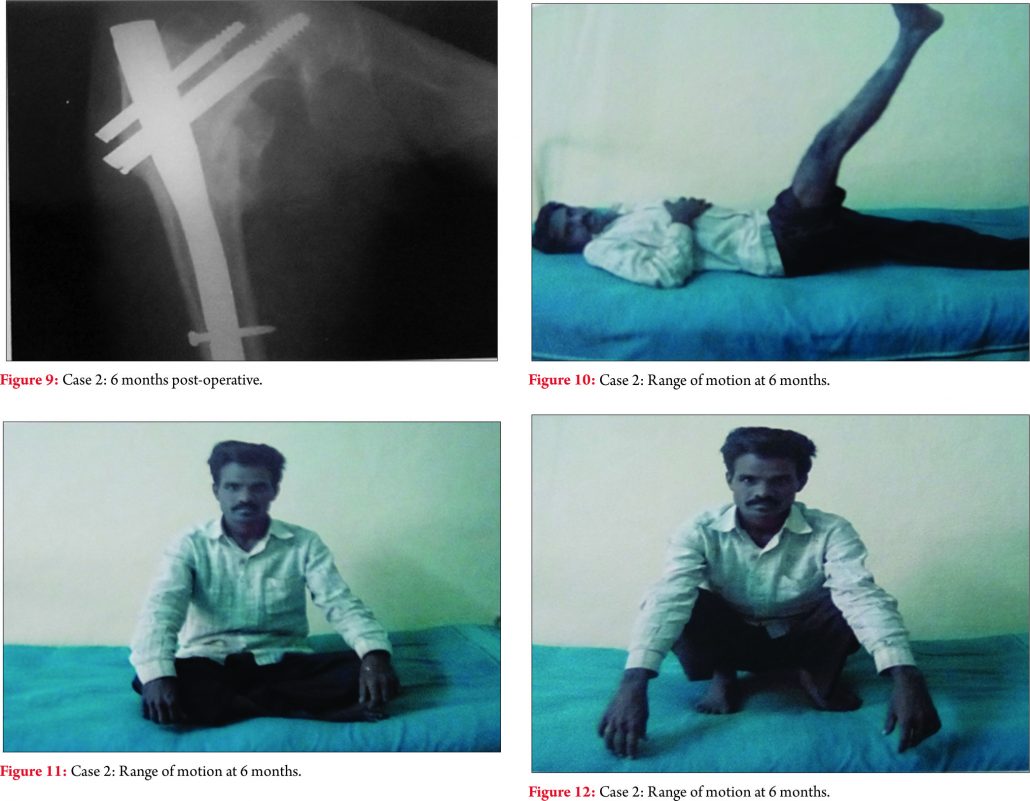 Functional Outcome of Unstable Intertrochanteric Femur Fracture ...