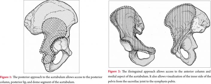 Where Do We Need More than One Approach for Acetabular Fractures and ...