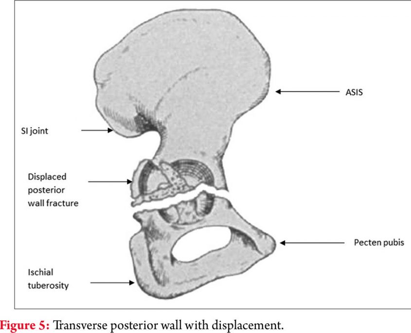Where Do We Need More than One Approach for Acetabular Fractures and ...