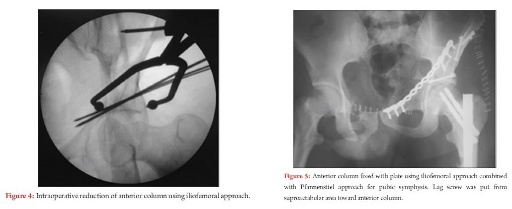 Iliofemoral Approach to Acetabulum – Trauma International