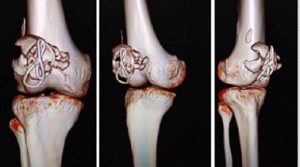 Multi-Fragment Patellar Non-Union in a Young Patient Due to Failed ...